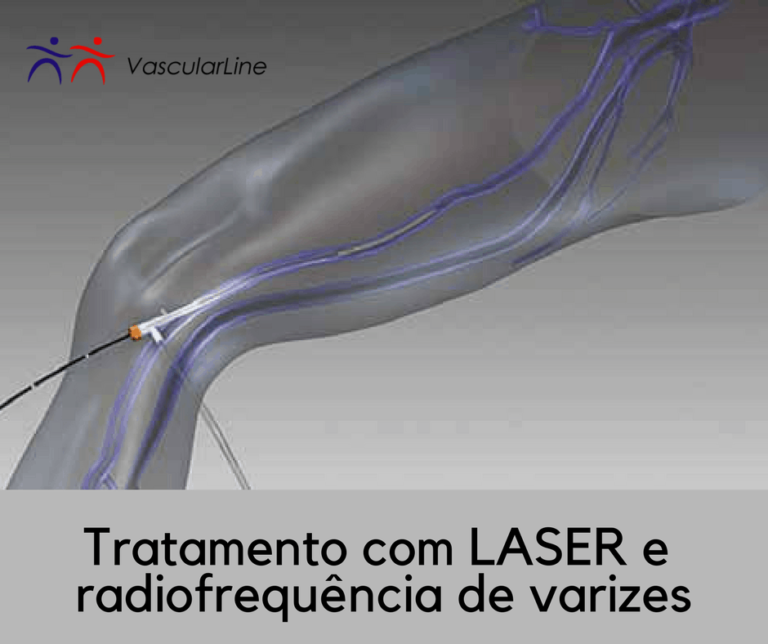 Laser para varizes, Moema, Campo Belo, SP
